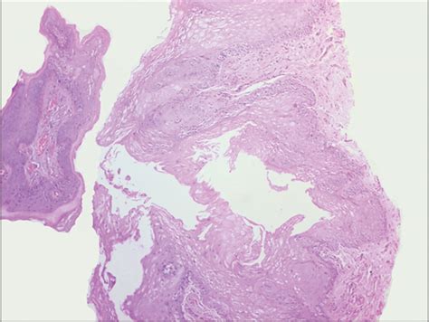 Asymptomatic Hyperpigmented Lesions On Tongue Indian Journal Of Dermatology Venereology And Asymptomatic Hyperpigmented Lesions On Tongue Indian Journal Of Dermatology Venereology And