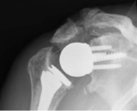 Uw Shoulder And Elbow Academy Acromial And Spine Fractures After Reverse Total Shoulder Risk