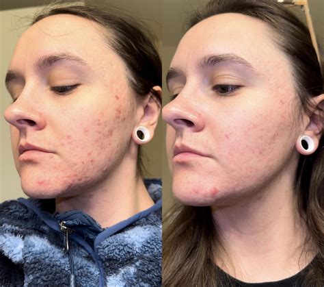 3 5 Month Progress On Tretinoin 0 05 R Tretinoin