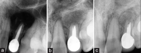Efficacy Of Decalcified Freeze Dried Bone Allograft In The Regeneration