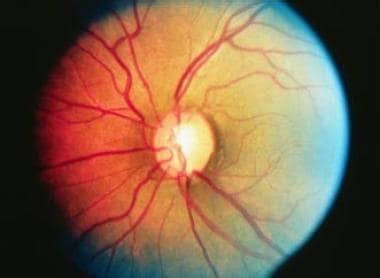 Primary Open Angle Glaucoma Poag Practice Essentials Background