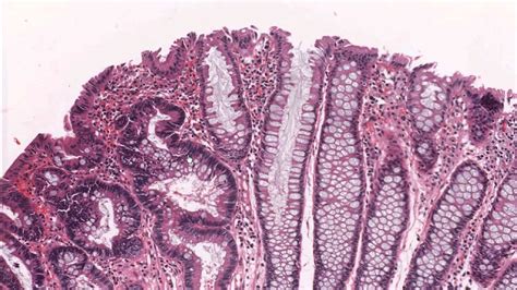 Tubulovillous Adenoma With Dysplasia