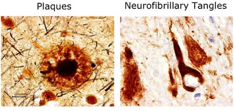 The Brain Plaques And Tangles That Cause Alzheimers Disease Big Think