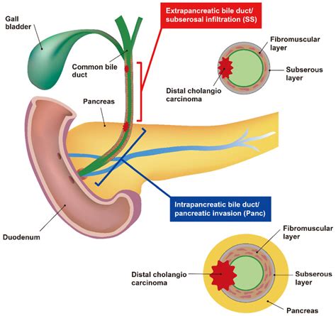 Diagnostics Free Full Text Subserosal Layer And Or Pancreatic Invasion Based On Anatomical