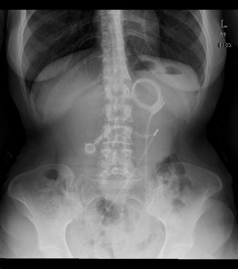 Slipped Gastric Band Image