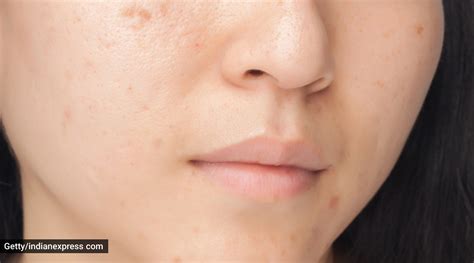 Say Goodbye To Stubborn Brown Spots On Your Face With These Simple Tips