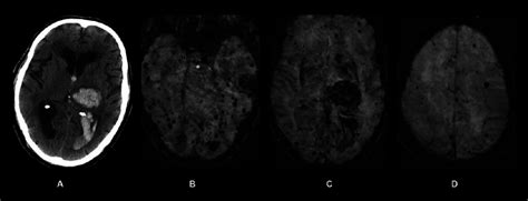 Computed Tomography Ct Of The Head Showing A Left Thalamic