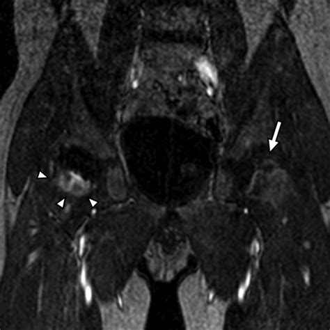 Mri Of Legg Calvé Perthes Disease Ajr