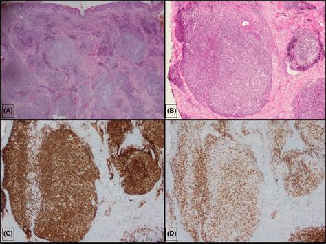 A‐d Lymphoid Infiltration He ×20 Showing Nodular Infiltration With Download Scientific