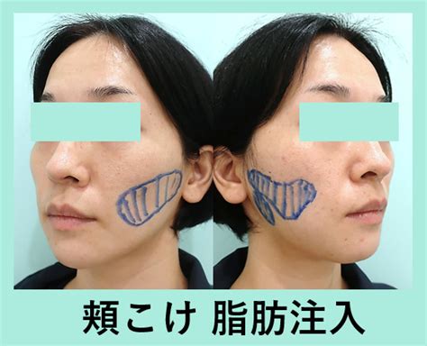 重度な頬コケも1回の脂肪注入でしっかり改善！ Womクリニック銀座