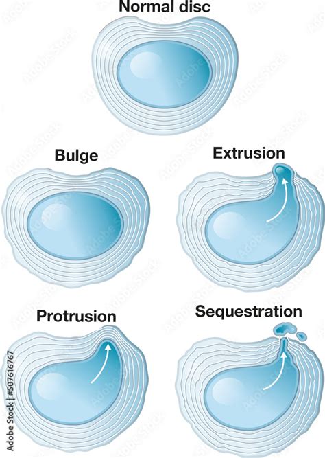 Herniated Disc Schema Normal Disc Bulge Protrusion Extrusion