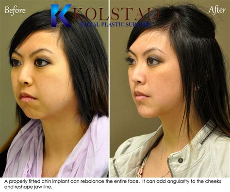 Chin Implant Before And After Asian