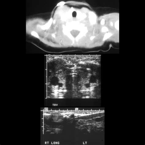 Infant With Torticollis And A Right Superior Chest Wall Mass