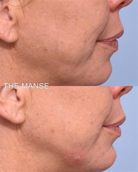 Jawline Dermal Filler Best Clinic Sydney For Dermal Fillers