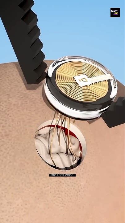 How Will The Nuralink Chip Implanted In The Brain Work Shorts