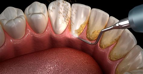 Limpieza Dental Profesional Clínica SAGA