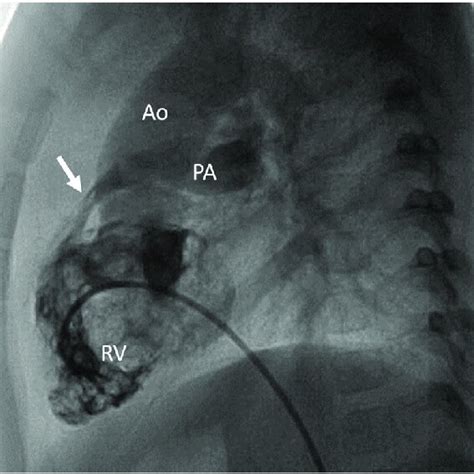 Lateral View Of The Patients Right Ventriculogram Before Tetralogy Of