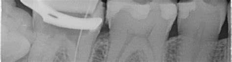Broken File In Root Canal During Root Canal Treatment