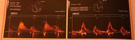Spectral Doppler Examination Flashcards Quizlet
