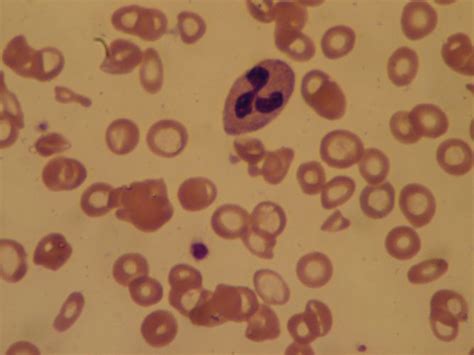 Hypochromic Microcytic Anemia Pathology Britannica