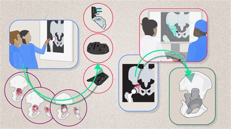 Managing Bone Defects Using Large Acetabular Cups And Highly Porous Augments