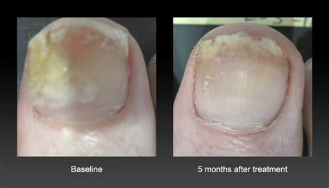 Laser Nail Fungus Removal Laser Medspa Treatments Atlanta