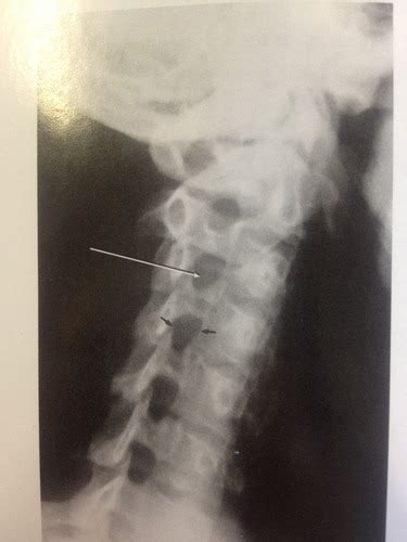C Spine T Spine Flashcards Quizlet