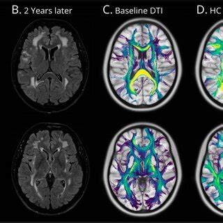 Figure MRI FLAIR Axial Images Performed At Symptoms Onset And 2 Years Download Scientific
