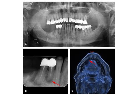 66 Year Old Man With Right Sided Oral Cavity Squamous Cell Carcinoma