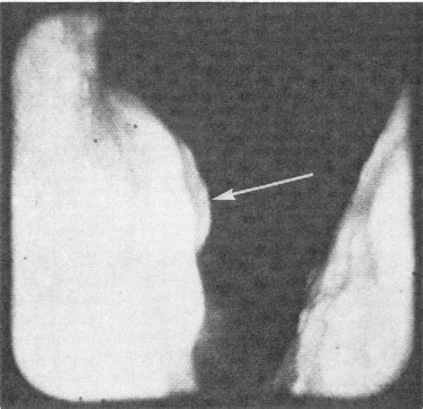 Figure 1 From Case Report Possible Phycomycetes Granuloma In The Larynx
