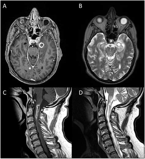 Mri Brain T1 Weighted Imaging Revealed Lesion With Ring Enhancement A