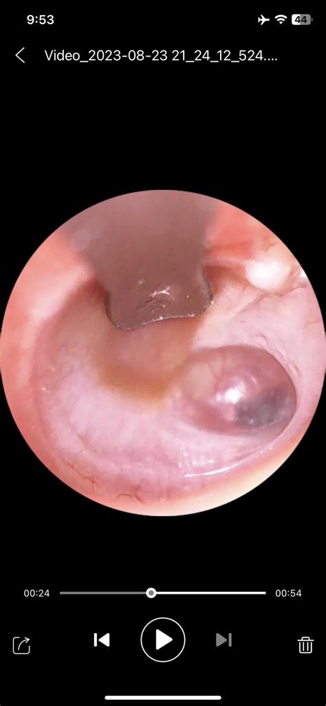 Left Ear Drum I Have Mild Hearing Loss Rearwax