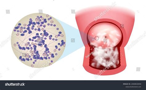 Illustration Candidiasis Infection On Cervix Candida Stock Vector