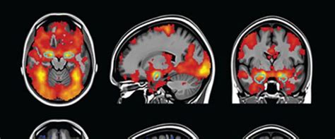 Brain Imaging Tests A Comprehensive Overview