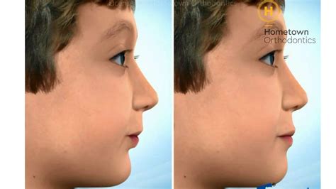Does Overbite Cause Weak Chin