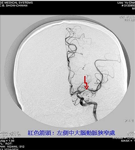 腦動脈狹窄惹禍 失神還昏厥 自由健康網