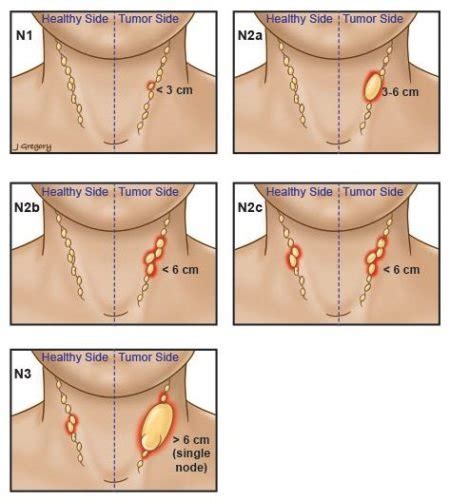 Tonsil Cancer Pictures Symptoms Survival Rate Staging Prognosis