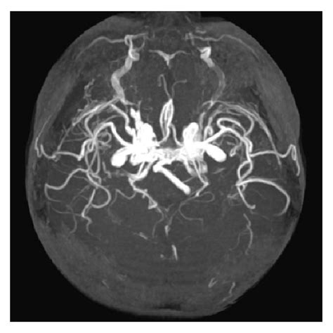 The Magnetic Resonance Angiogram Mra Of The Patient Showed Increased