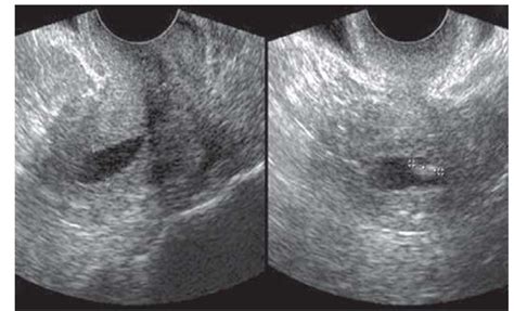 A Transvaginal Scan Showing An Endometrial Fluid Collection