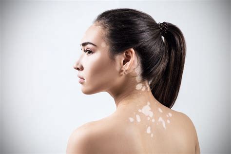 What Is Vitiligo And How Is It Treated Garden City Ny And Syosset Ny Borealis Dermatology