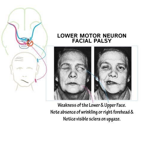 Neuroanatomy Glossary 7th Nerve Palsy Ditki Medical And Biological