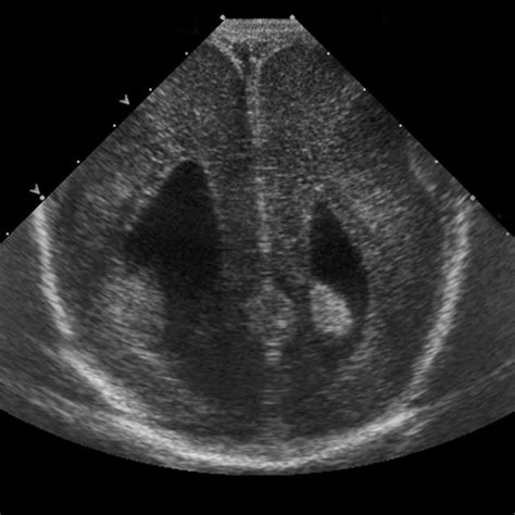 Lissencephaly Pictures