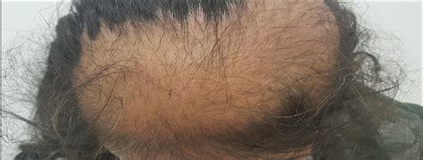 International Journal Of Trichology