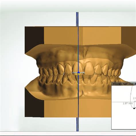 Overbite Measurement In The Digital Model Using The Ortho Analyzer