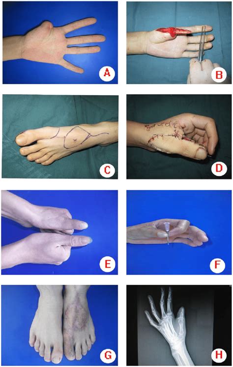 A Preoperative Defect Proximal To Metacarpophalangeal Joint In The