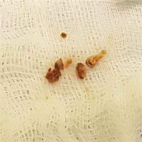 Observation Of A Well Formed Punctum After 4 Snip Punctoplasty And