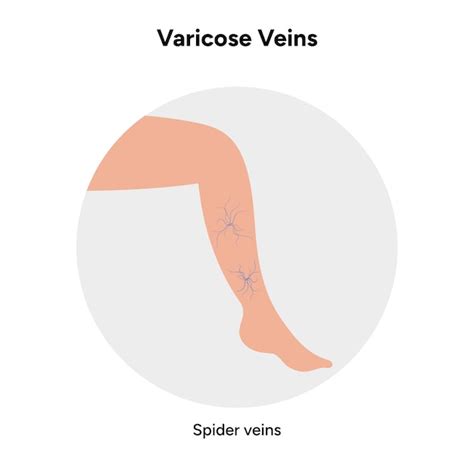 Premium Vector Varicose Veins Spider Veins