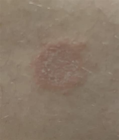 Ringworm T T Doesnt Look Gross Just Spoiler Ing In Case Rdermatologyquestions