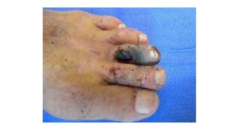 Gangrenemacroscopic Death Of Tissue With Putrefaction Pre Gangrene