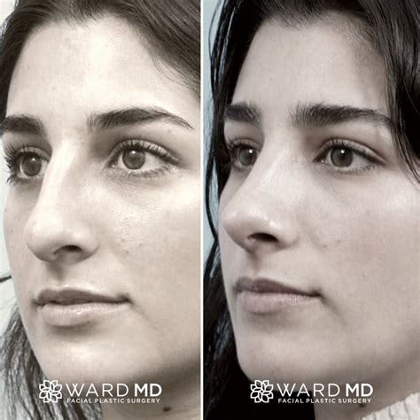 Ward Md Rhinoplasty This Patient Had The Ward Md Rhinoplasty Signature